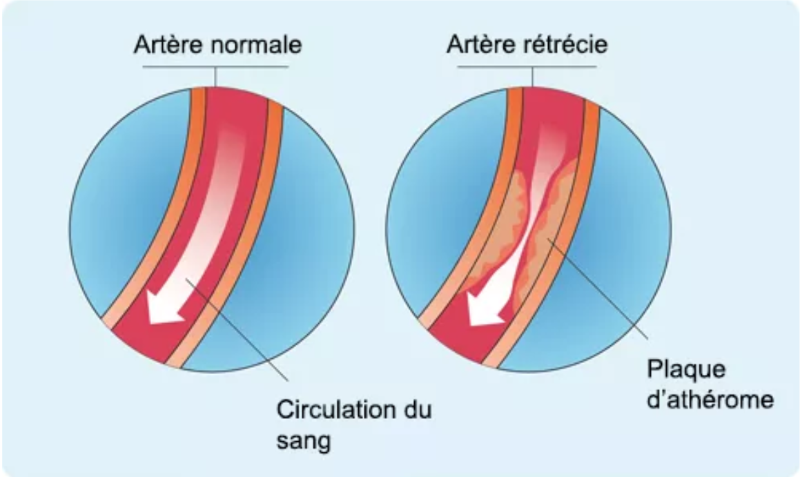 Alimentation et maladies cardiovasculaires